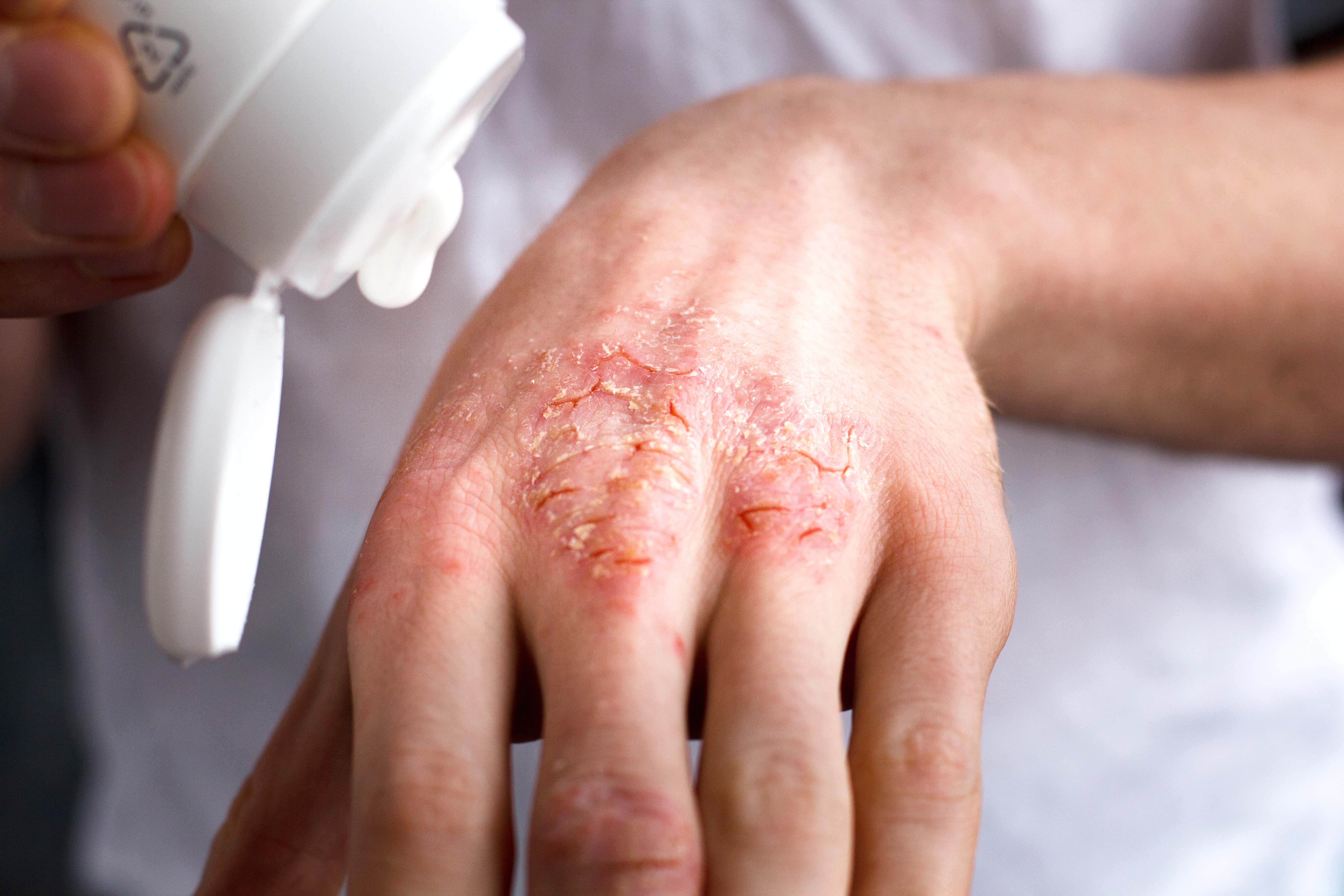 Psoriasis Hands